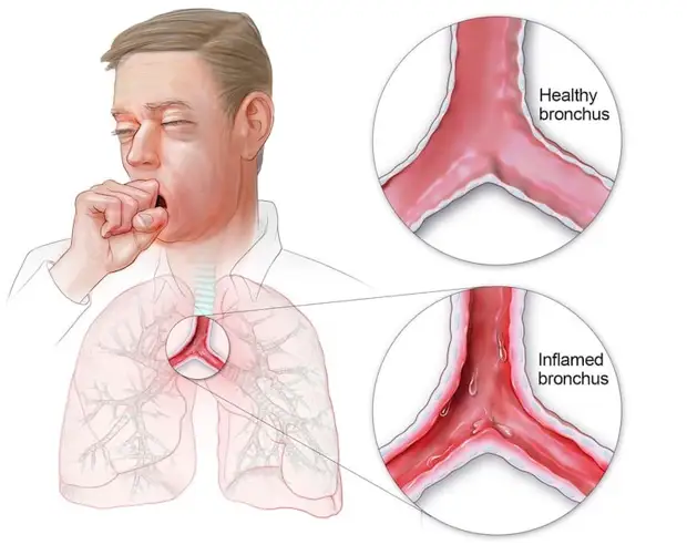 Cơn ho kèm theo viêm phế quản có thể kéo dài đến 8 tuần; điều này buộc những người bị viêm phế quản phải tìm kiếm các biện pháp chữa trị để đối phó với nó. chuối, bệnh, mật ong, lời khuyên, thủ thuật